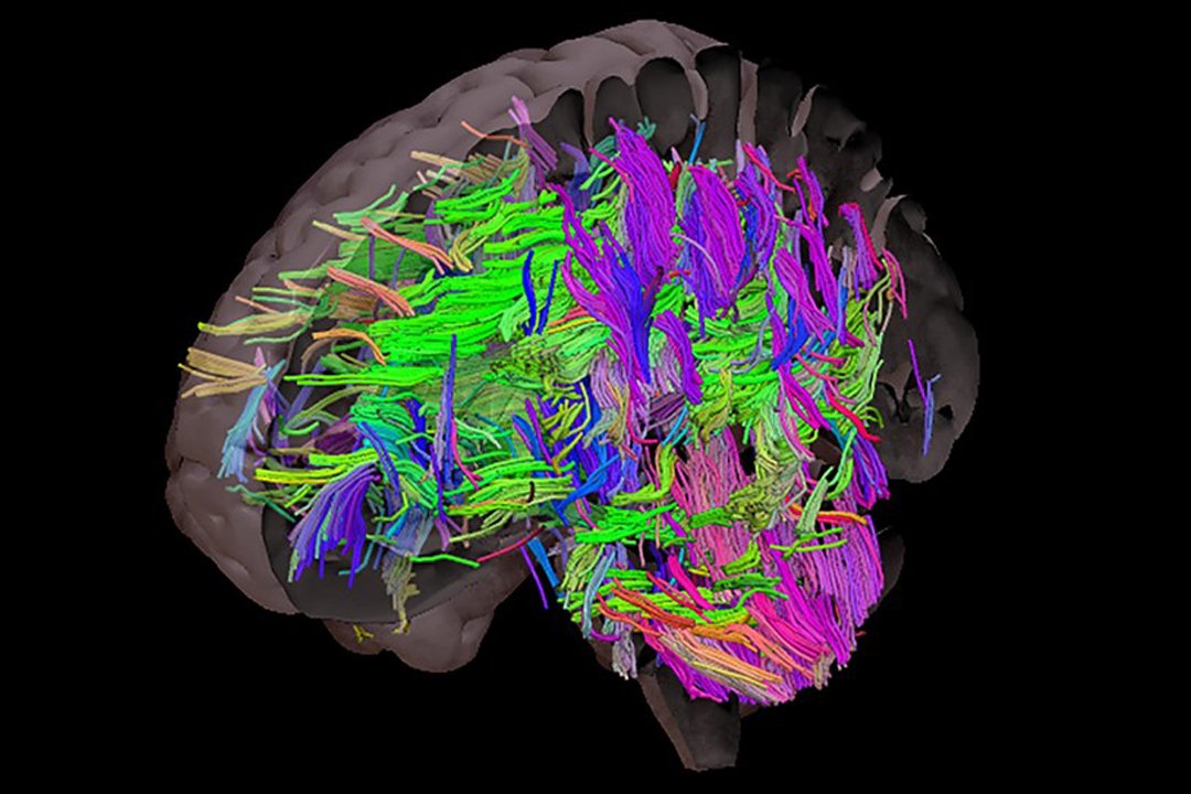 Obesity may exacerbate the effects of Alzheimer's disease, new study ...