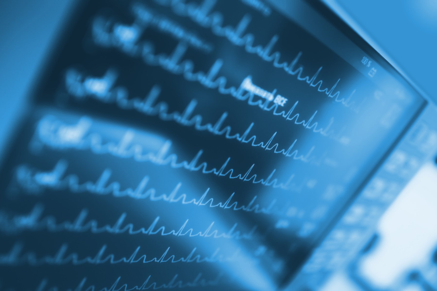 Improved detection of atrial fibrillation could prevent disabling strokes - Medical Update Online