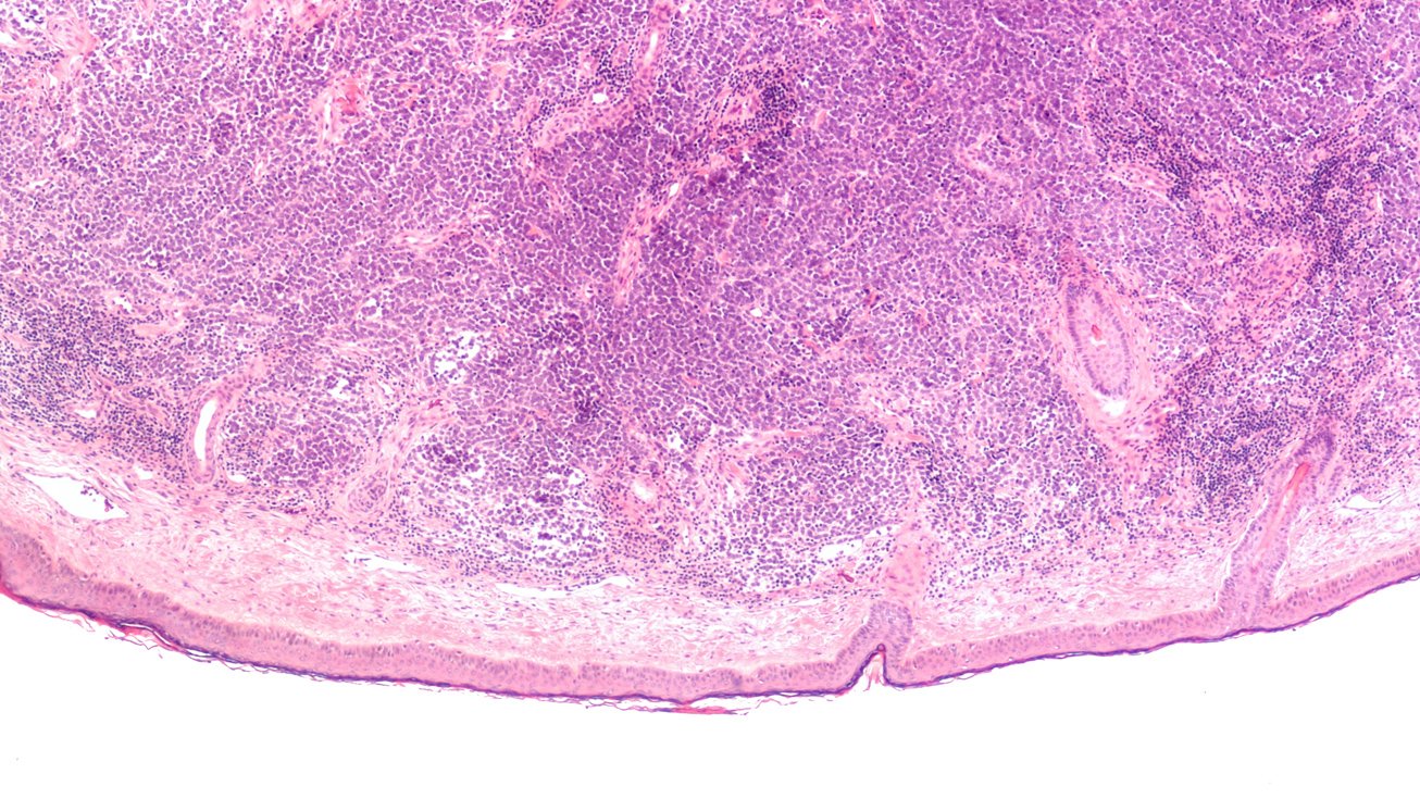 Patients with rare skin cancer face 40% recurrence rate - Medical ...