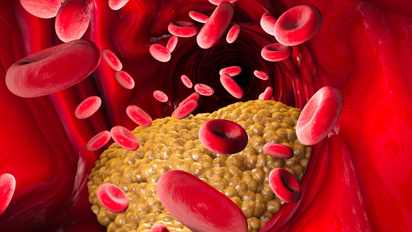 Even with statins, high triglycerides may increase risk of second ...