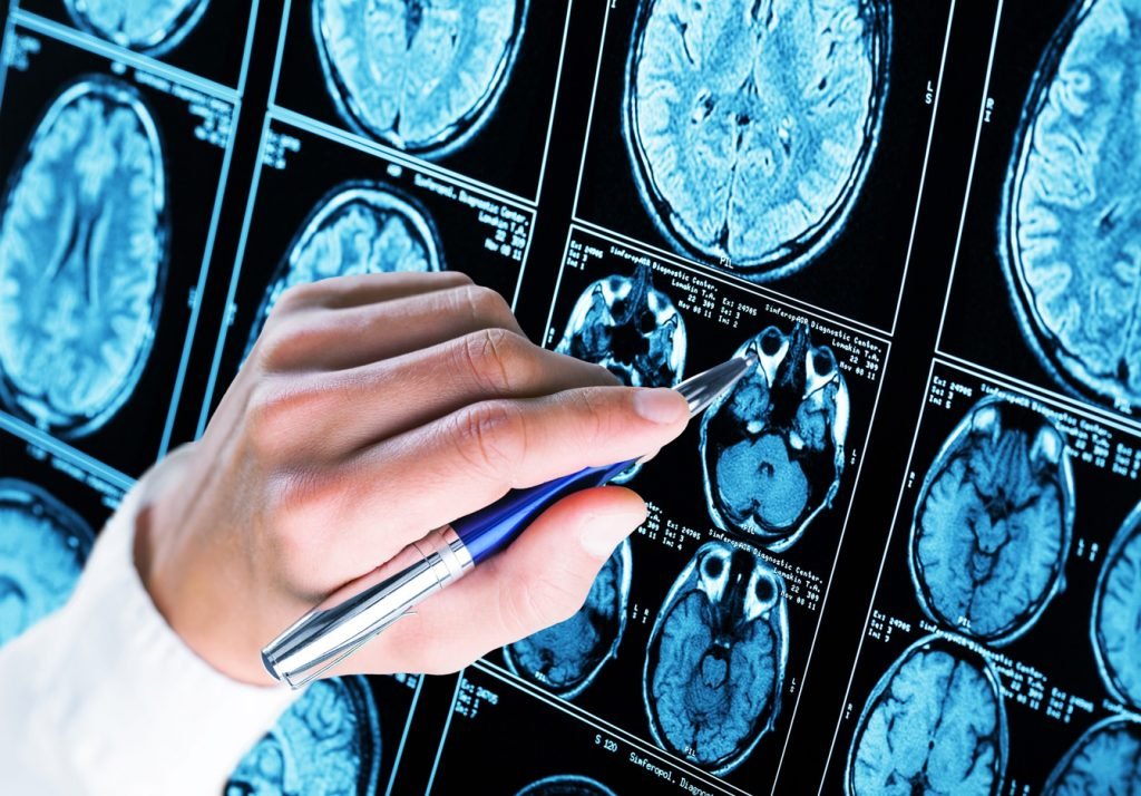 AI algorithm that detects brain abnormalities could help cure epilepsy ...