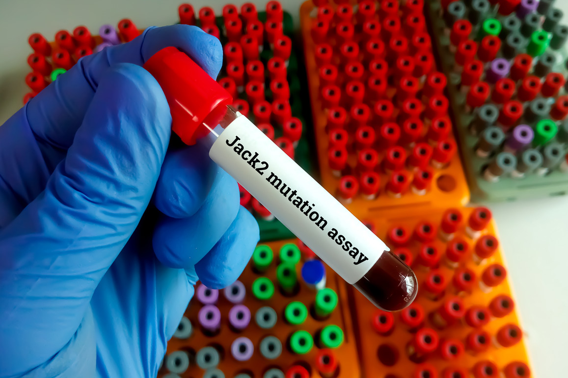 Study reveals how chronic blood cancer transitions to aggressive ...