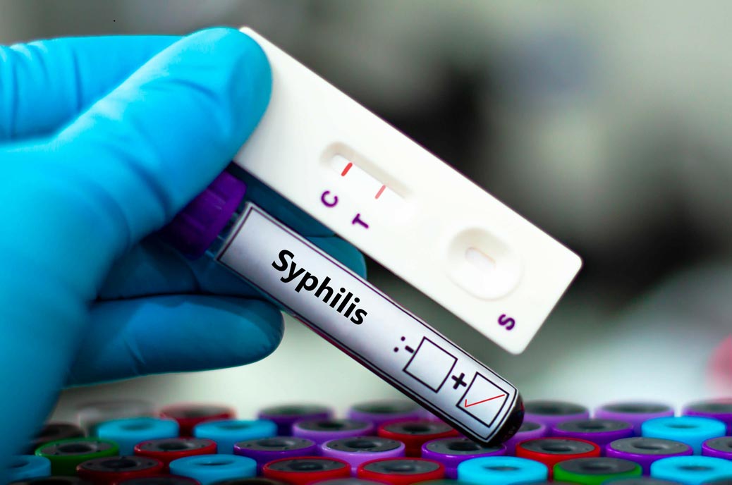 Syphilis cases are rising, but many people don’t know symptoms ...