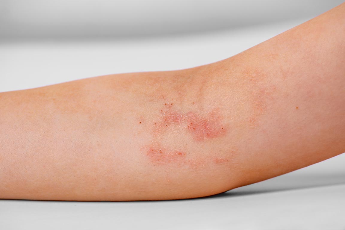 FDA approval for Ebglyss (lebrikizumab) to treat atopic dermatitis ...