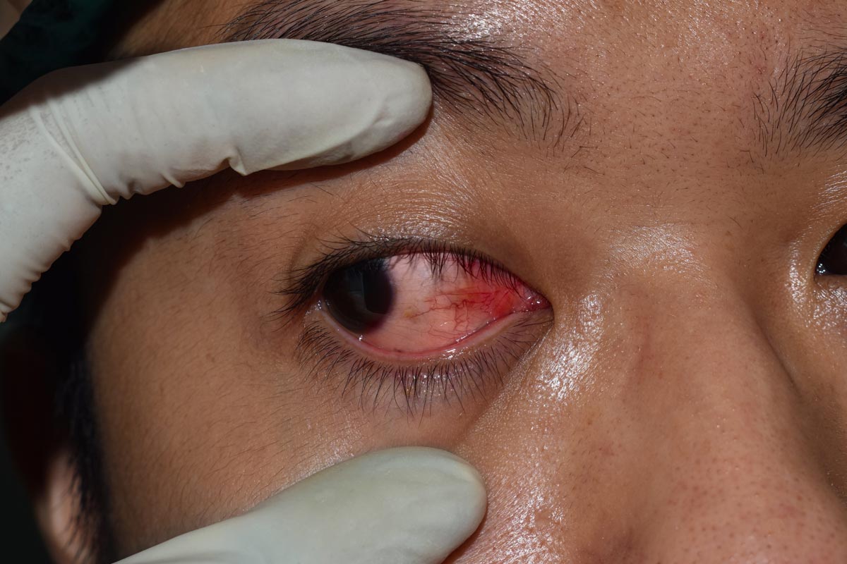 AI eye to eye with ophthalmologists in diagnosing corneal infections ...