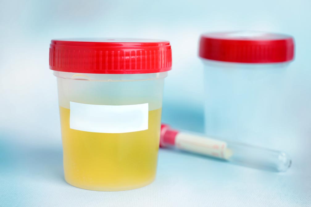 Urine-based test detects aggressive prostate cancer - Medical Update Online