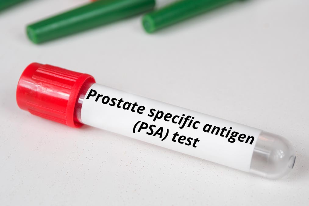 New research highlights wide variation in prostate cancer testing ...