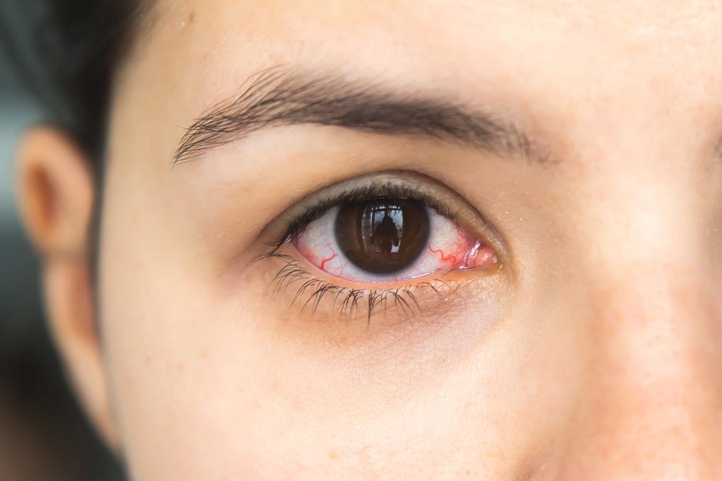 For eye infections, delayed doctor visits and extent of damage affect ...